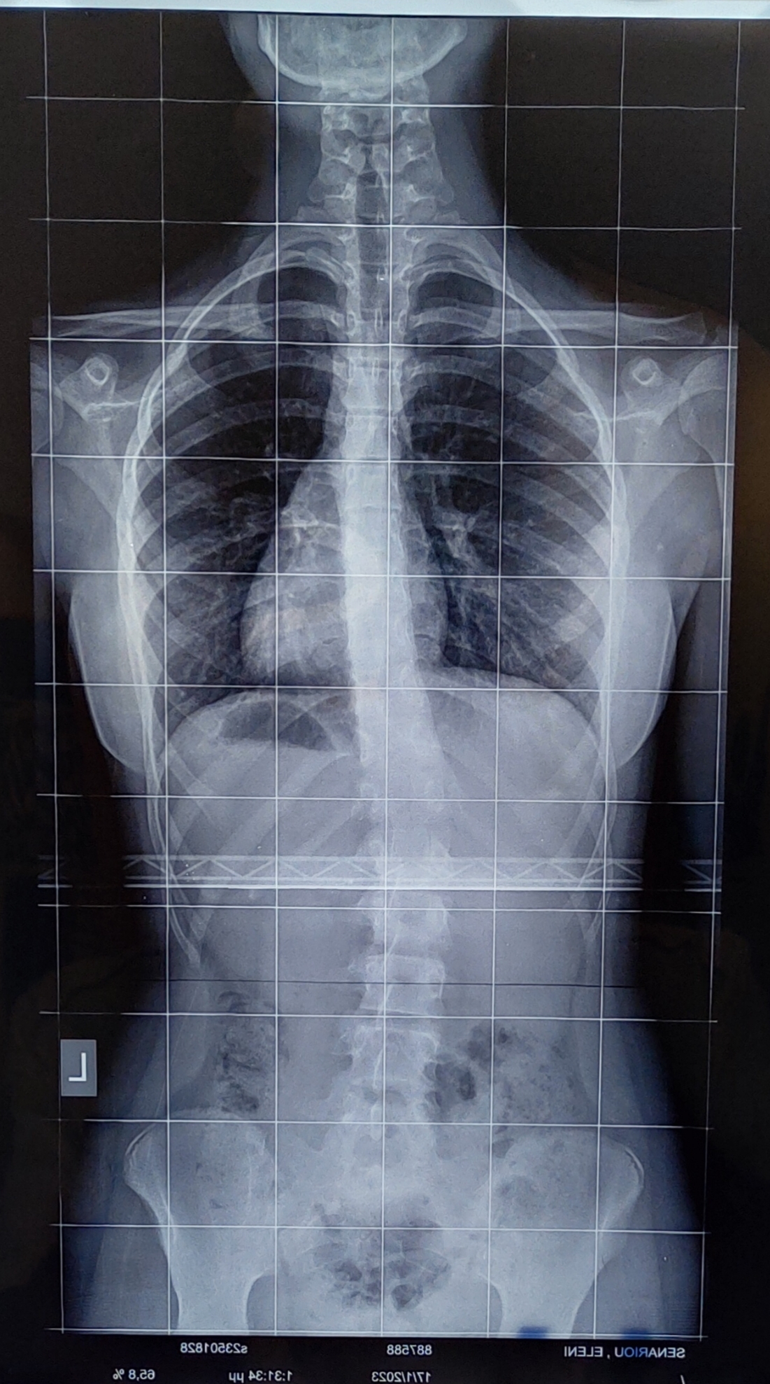 Σκολίωση: Διάγνωση, Θεραπεία & Συμβουλές| Physiomedia.gr
